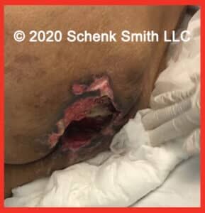 Bed Sore Stages with Pictures | Schenk Nursing Home Abuse Law